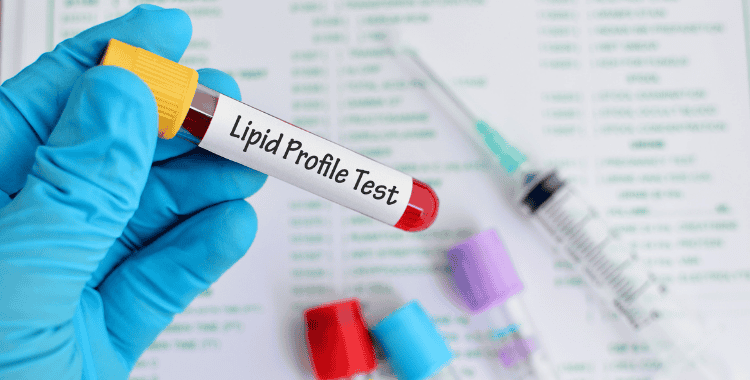 Best Diagnostic Centre for Lipid Profile Test in Bangalore | Janasnehi ...